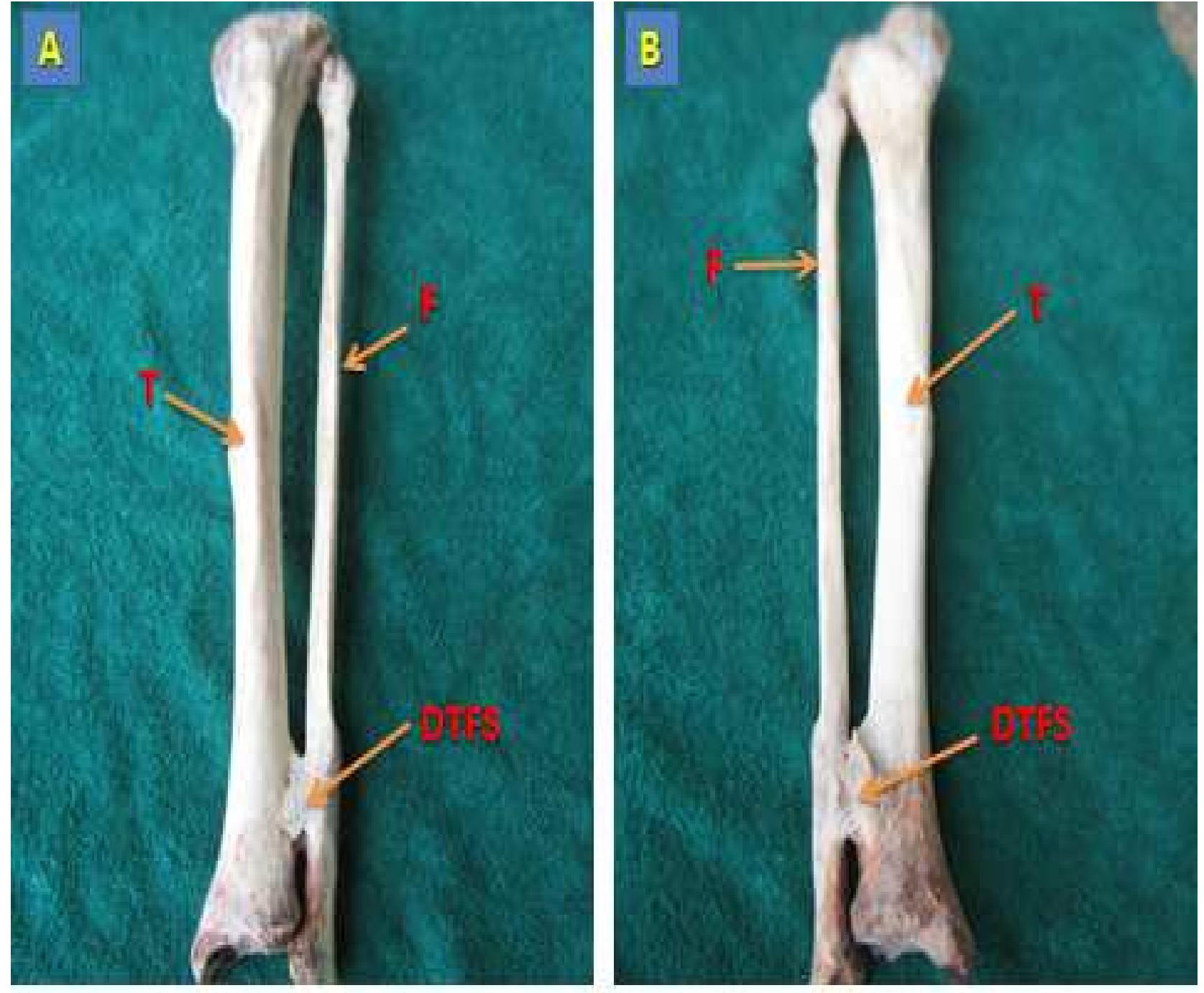 Photographs of the left tibia and fibula showing distal