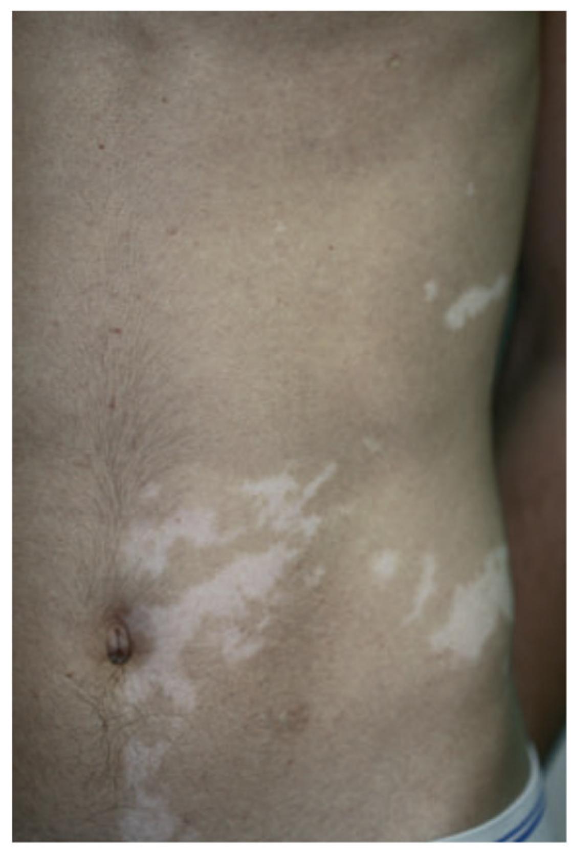 Figure 6 - Revised classification/nomenclature of vitiligo