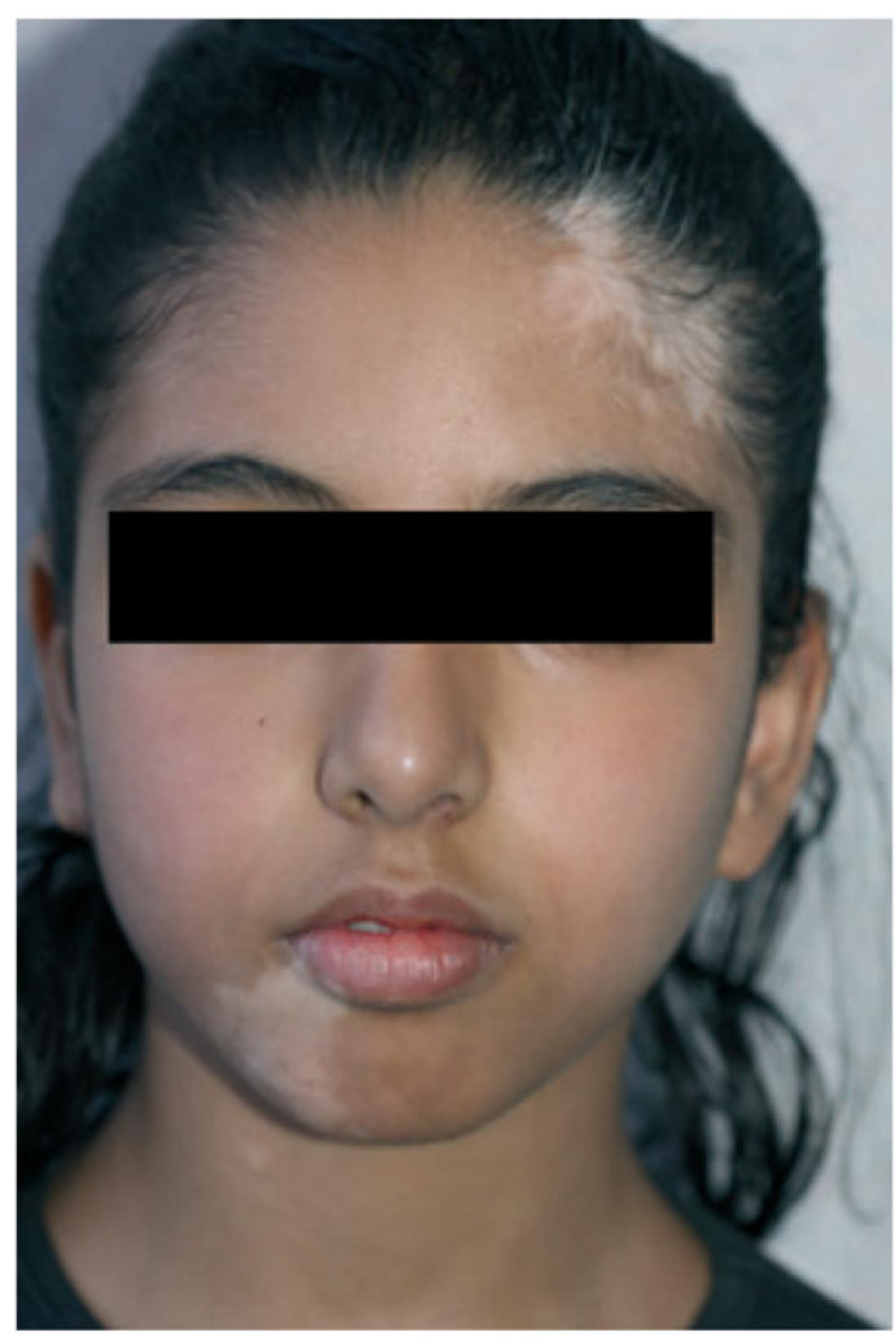 Figure 7 - Revised classification/nomenclature of vitiligo