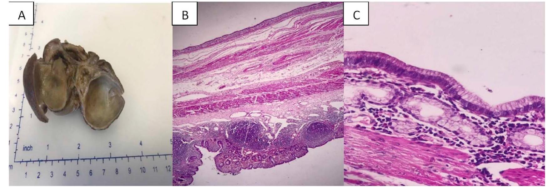 A. gross pathology (unilocular intramural cecal cyst) b.