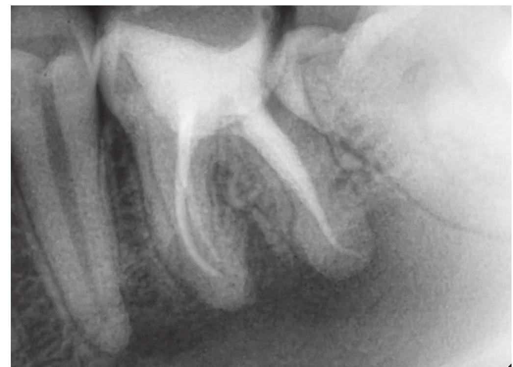 Periapical radiograph shows the extent of the lesion under