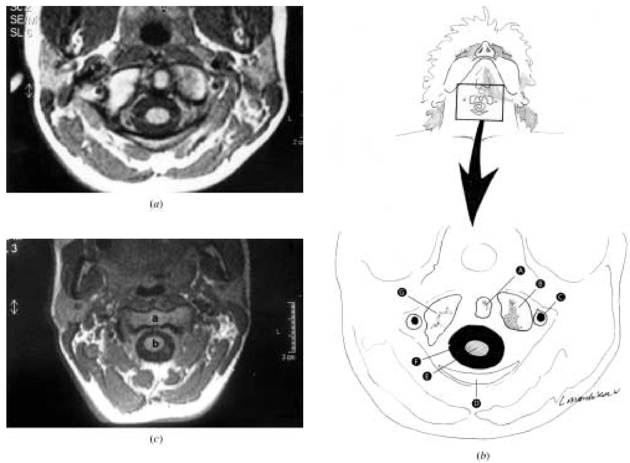 t1-weighted axial mri of normal volunteers. (a) mri at the t1-weighted axial mri of normal volunteers. (a) mri at the
