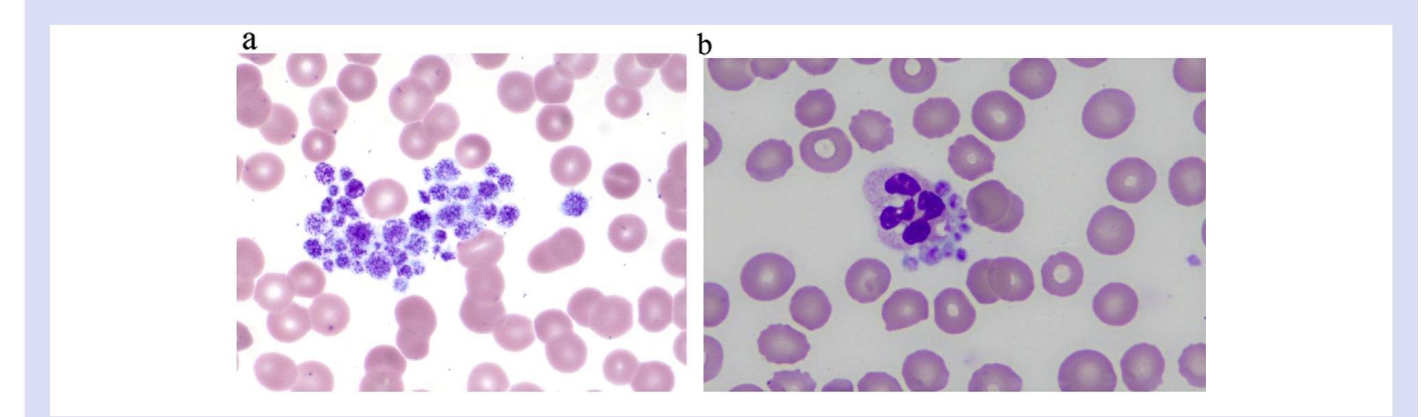 Artifactual thrombocytopenia. (a) platelet clumping