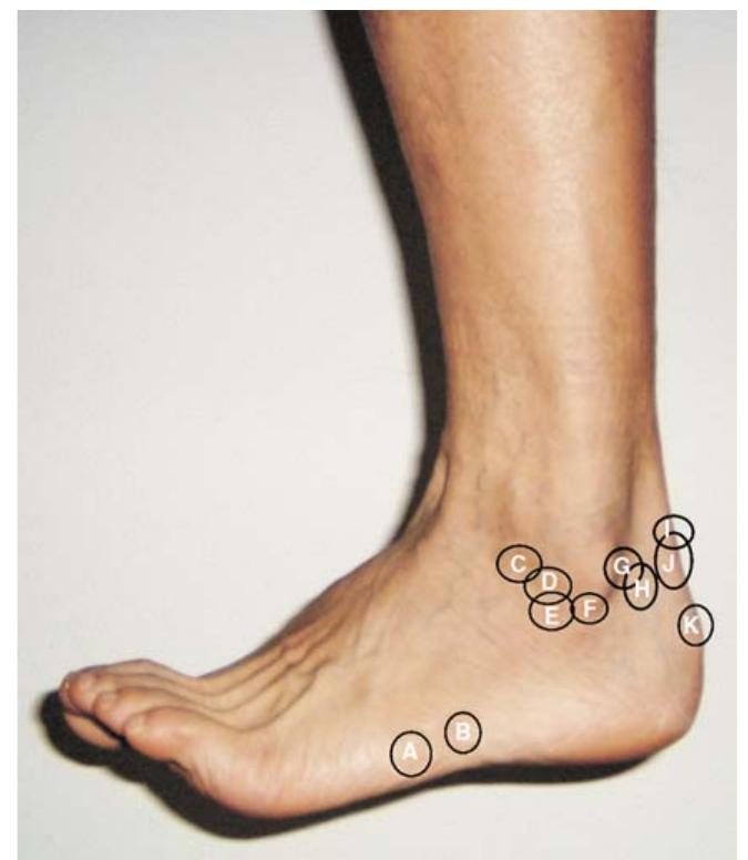 Lateral foot and ankle—typical locations of injury symptoms