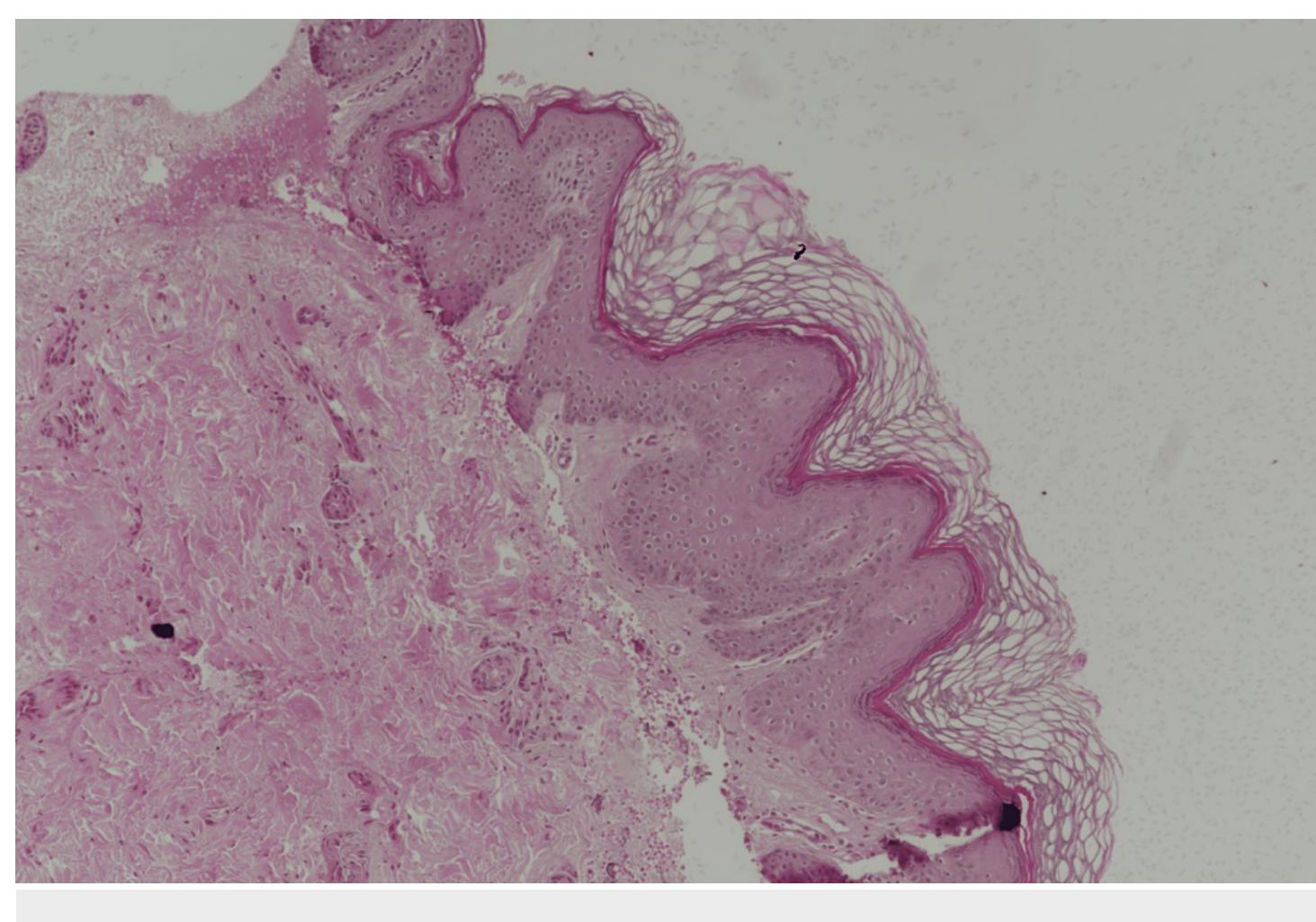 Pathology a2-mm punch skin biopsy of the papule revealed