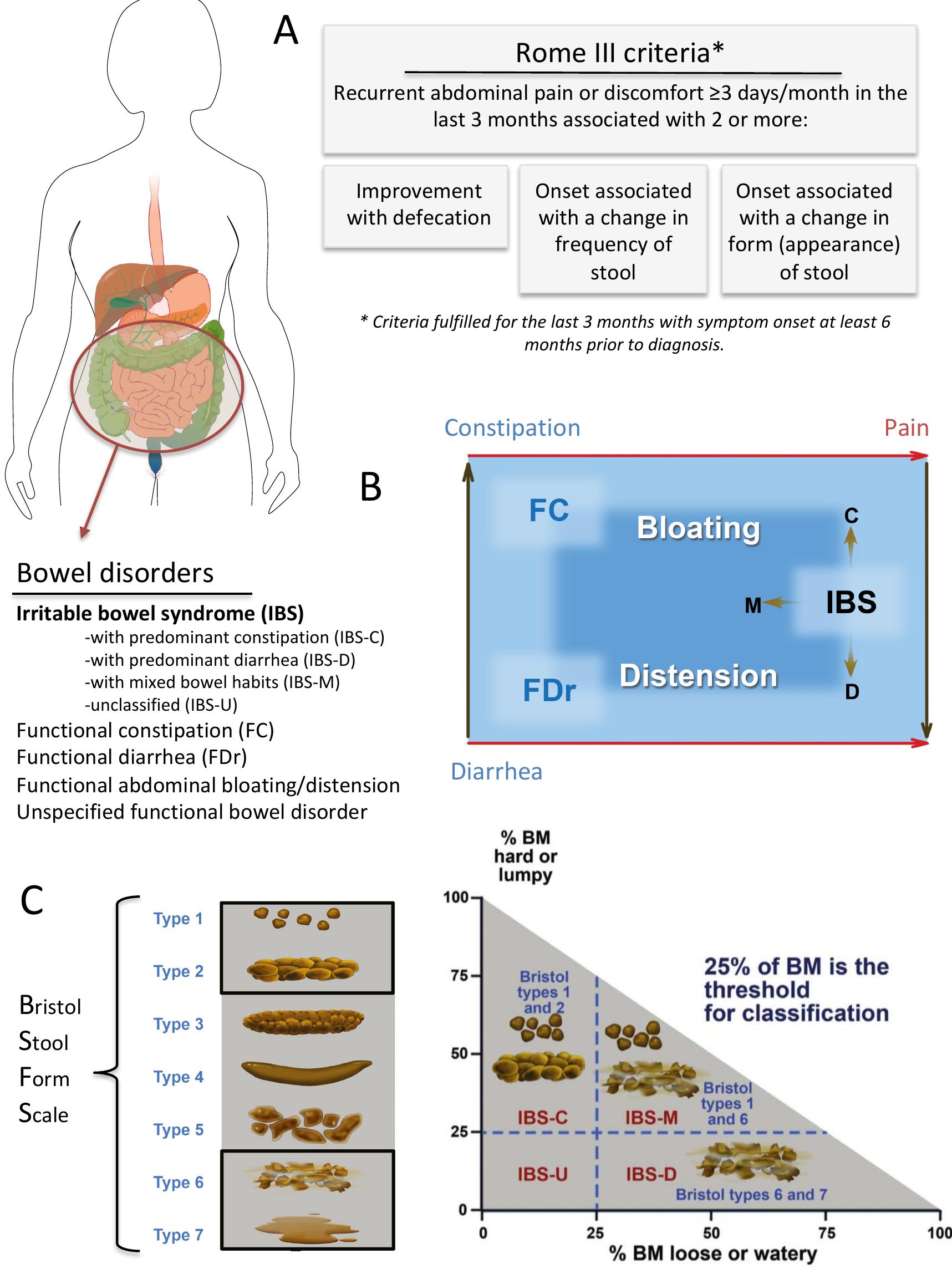 Rome iii criteria classification of ibs and its subtypes.