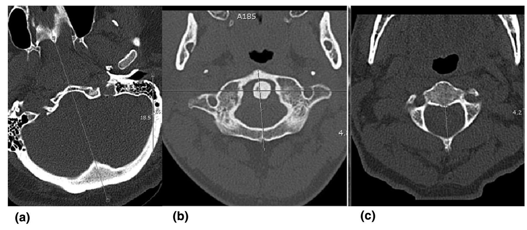 Example for head rotation measurement of co, cl, and c2