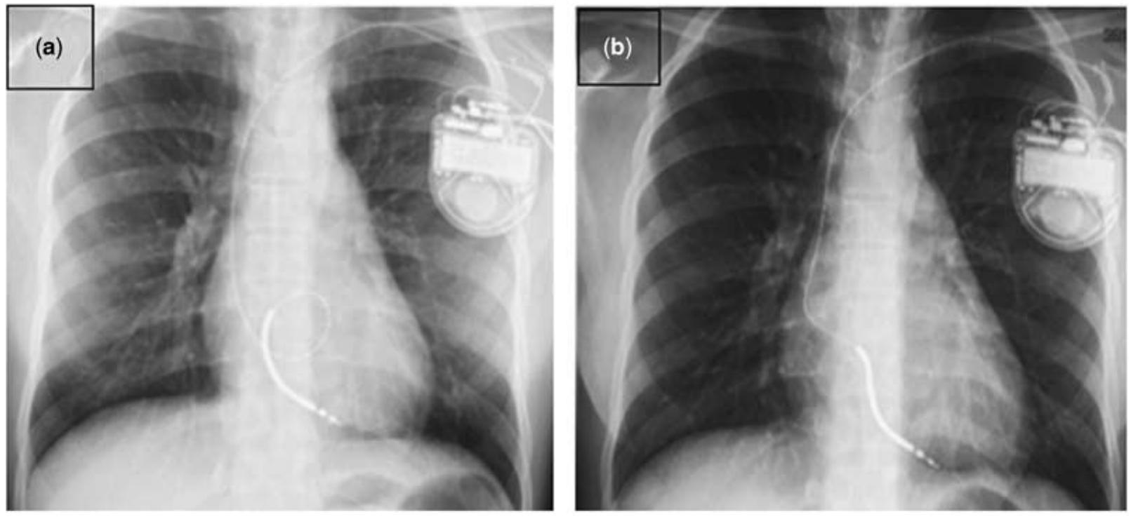 A) chest radiograph after implantation of a transvenous
