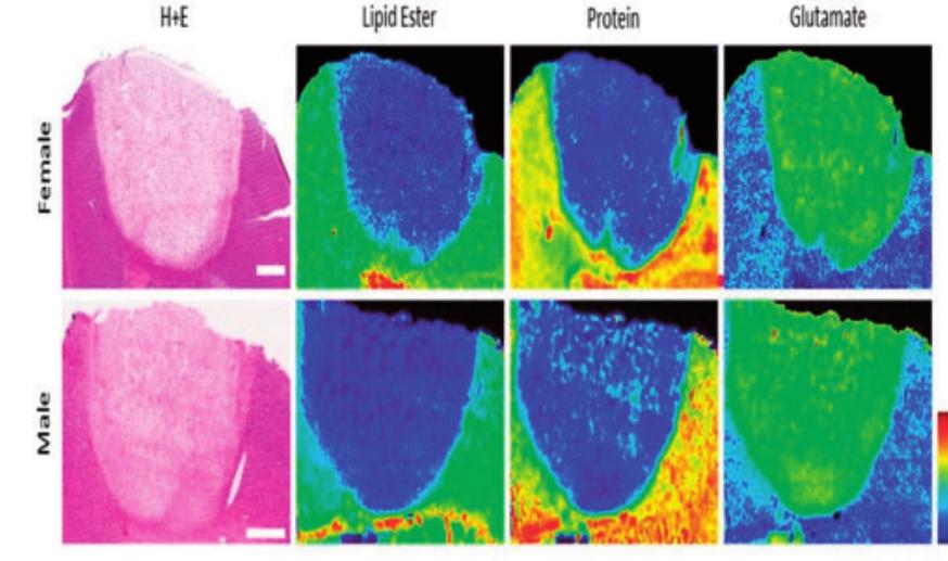 Stroke lesion morphology, shown by h+ staining, as well as