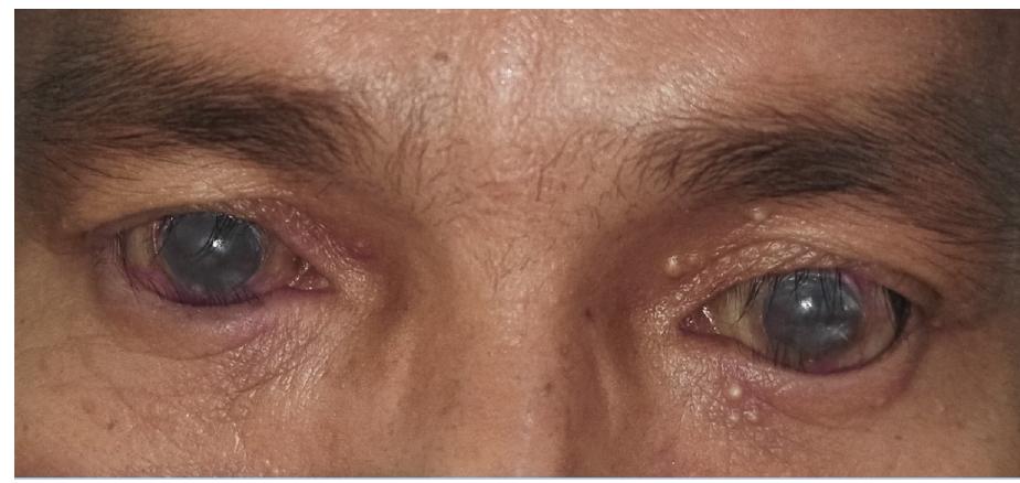Entropion and trichiasis of eyelids of both eyes seen in a