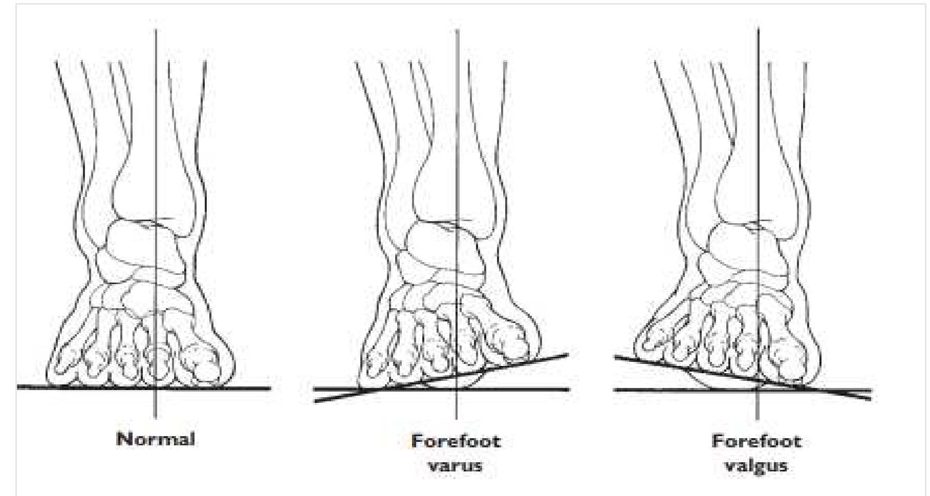 7 a diagram showing normal foot, forefoot varus and forefoot