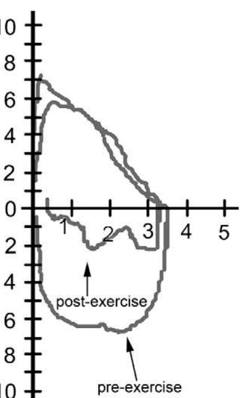 Spirometry before and after exercise in the girl described