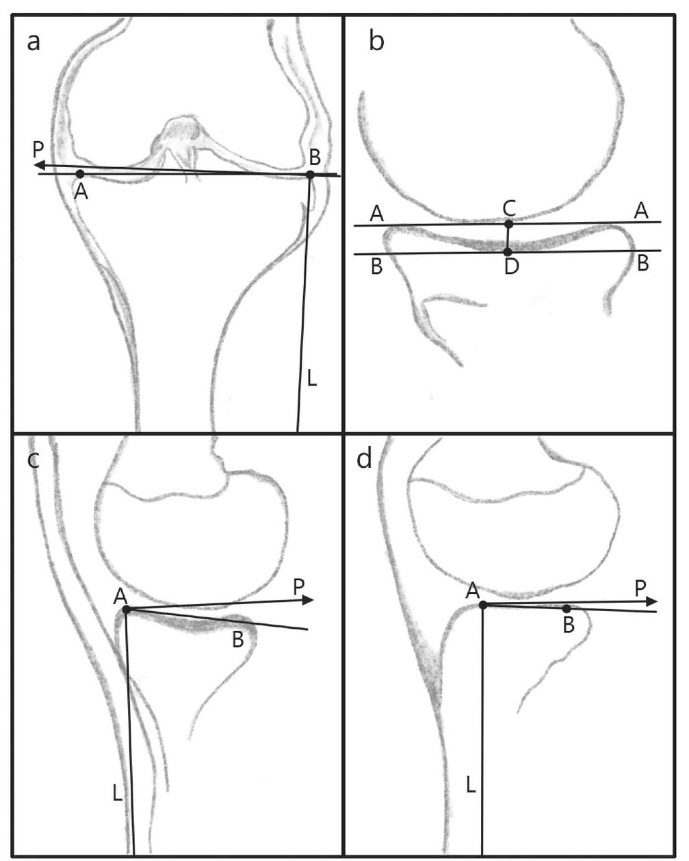 Method of tibial plateau assessment with magnetic resonance