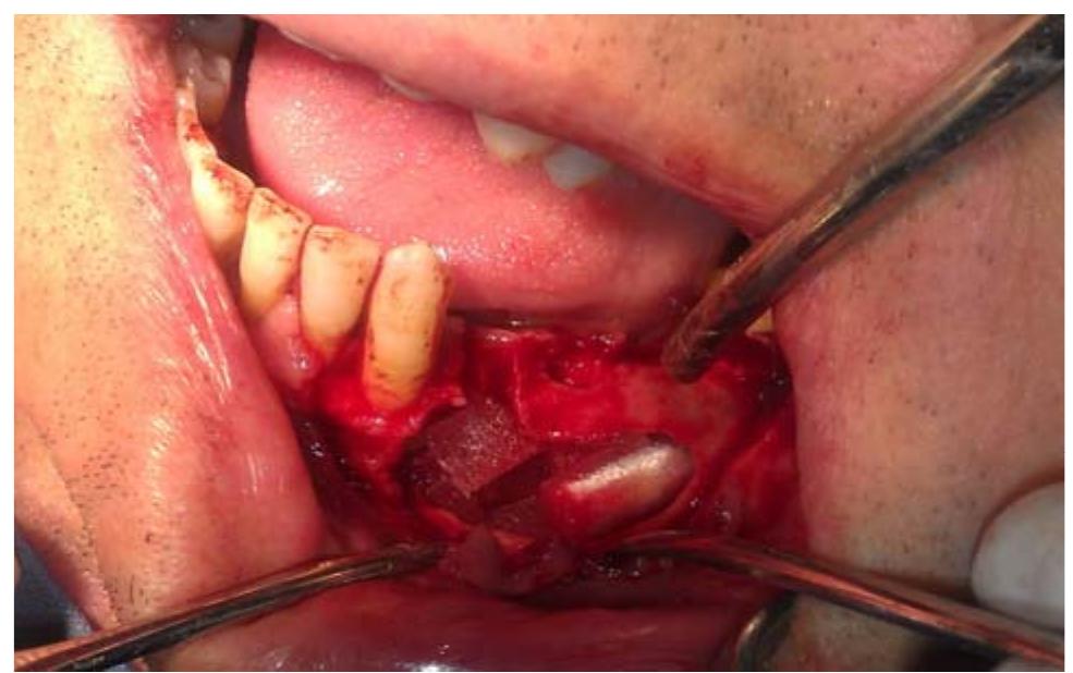 intraoral reconstruction of the mandibular defect with