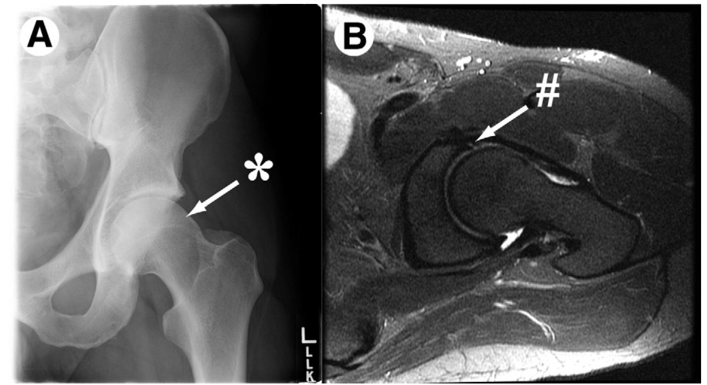 Example of cam impingement. (a) ap radiograph of a