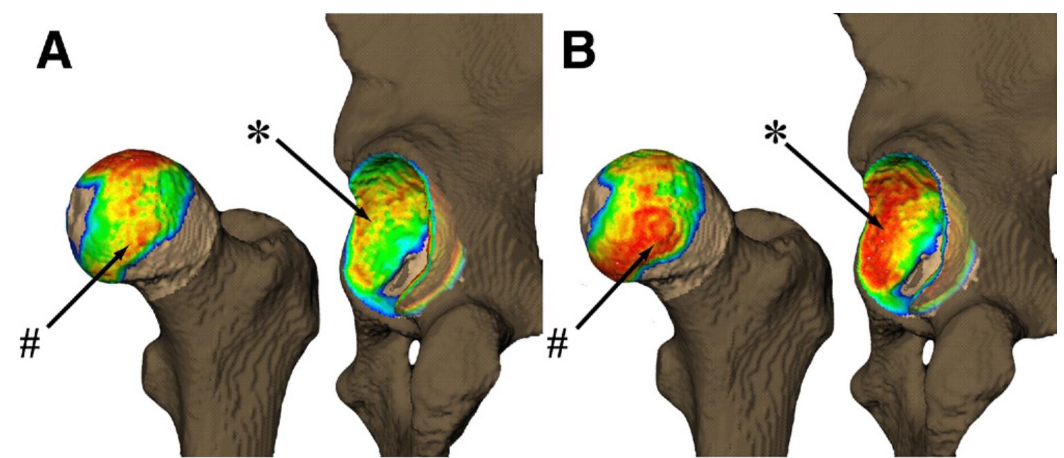Hip joint contact analysis in cam impingement. joint contact