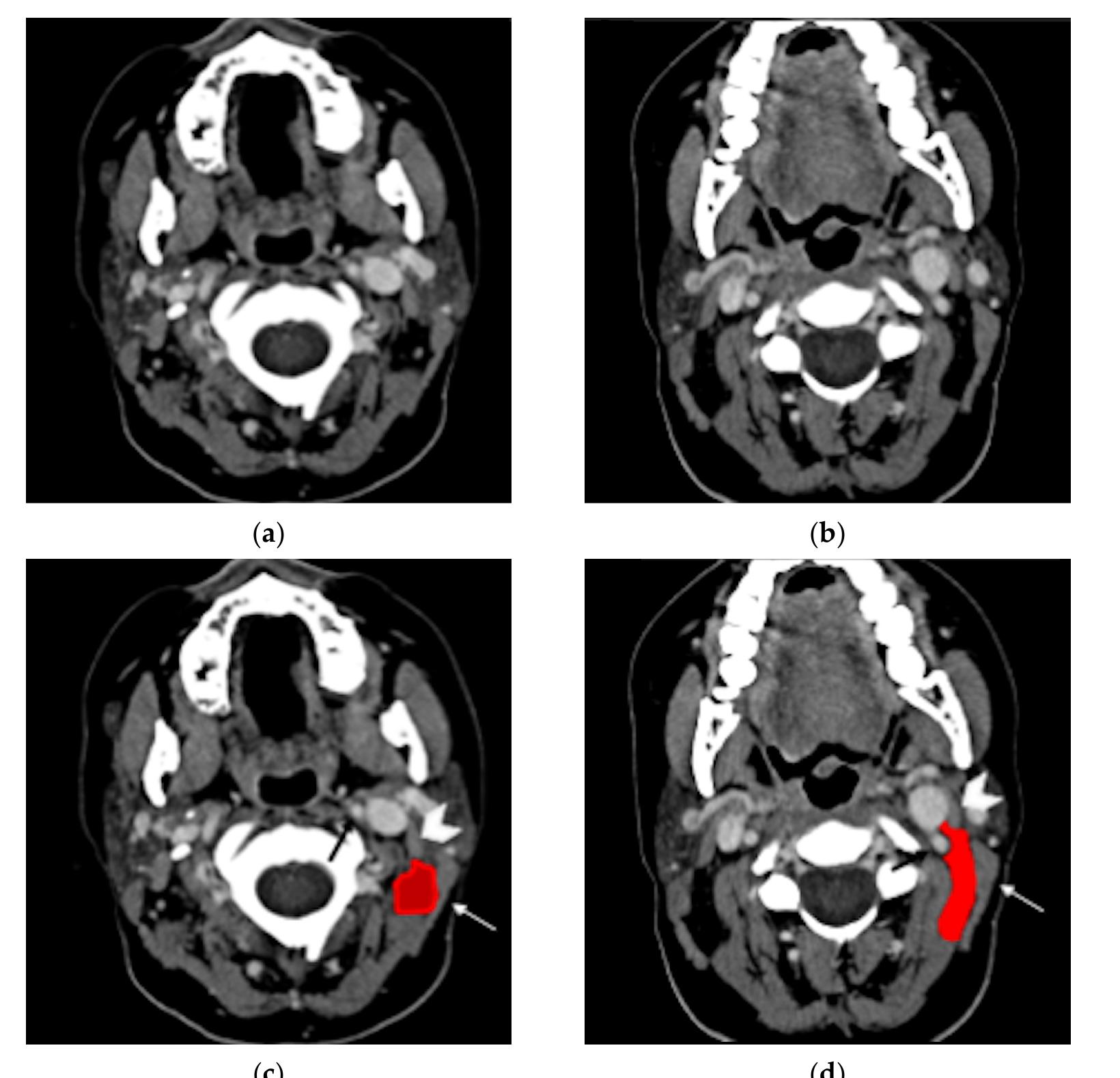 Normal anatomy, post-contrast axial ct (a,b). in the same