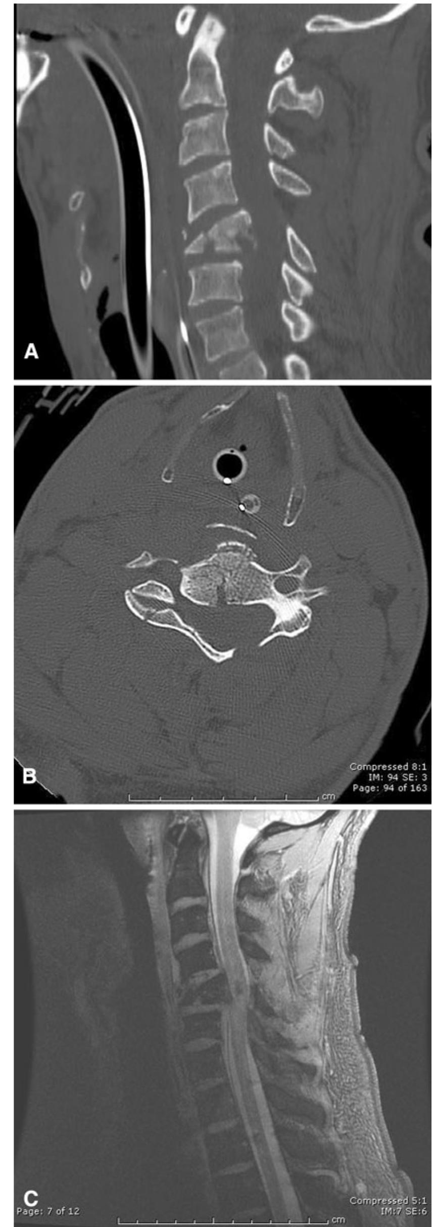 A-c (a) sagittal and (b) axial ct images depict a c5 flexion