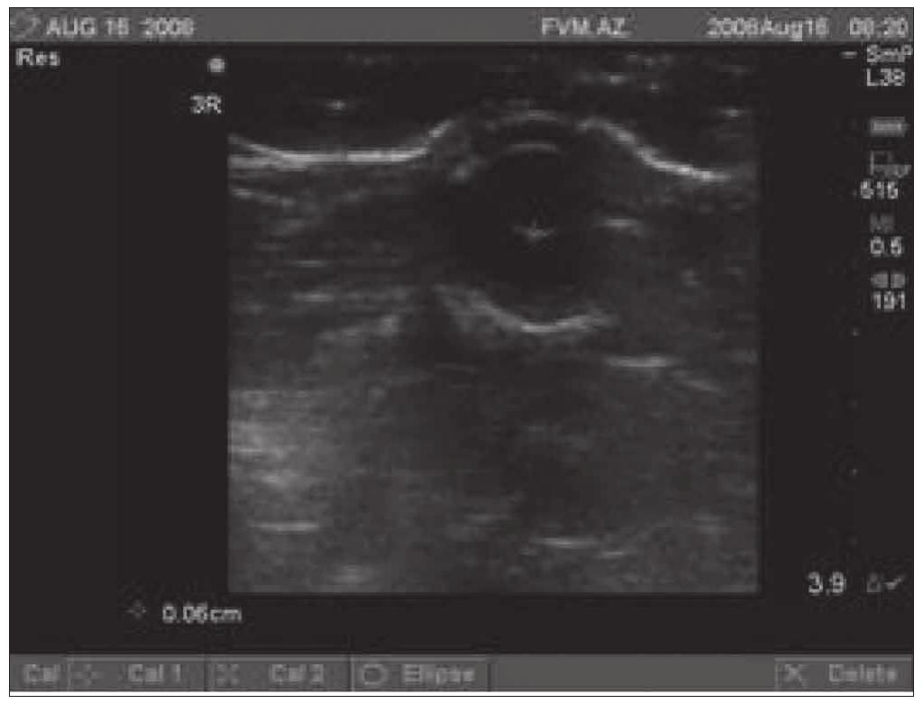 Increase of posterior lens capsule thickness following
