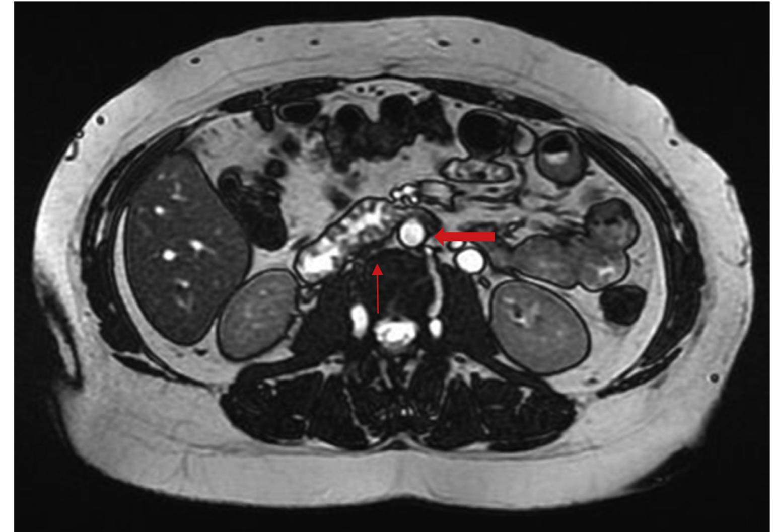 - axial 2d fiesta image at the level of the infrarenal