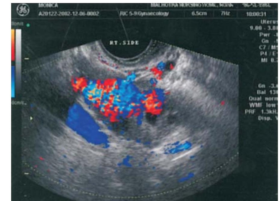 Figure 2 - from Sonosalpingography