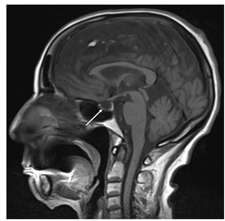 An mri sagittal t1 shows a fully empty sella. fig. 10. an