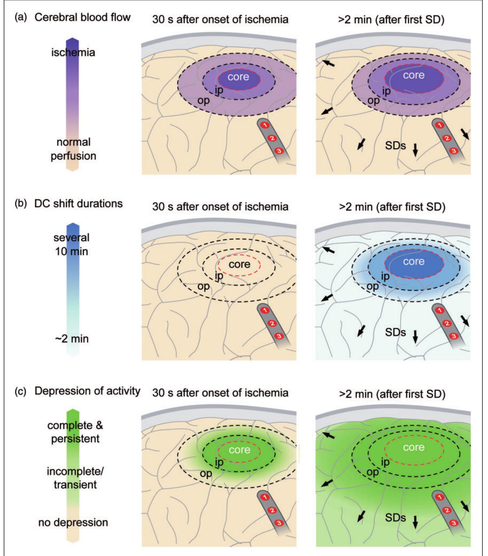 Pathophysiology of focal cerebral ischemia. in the