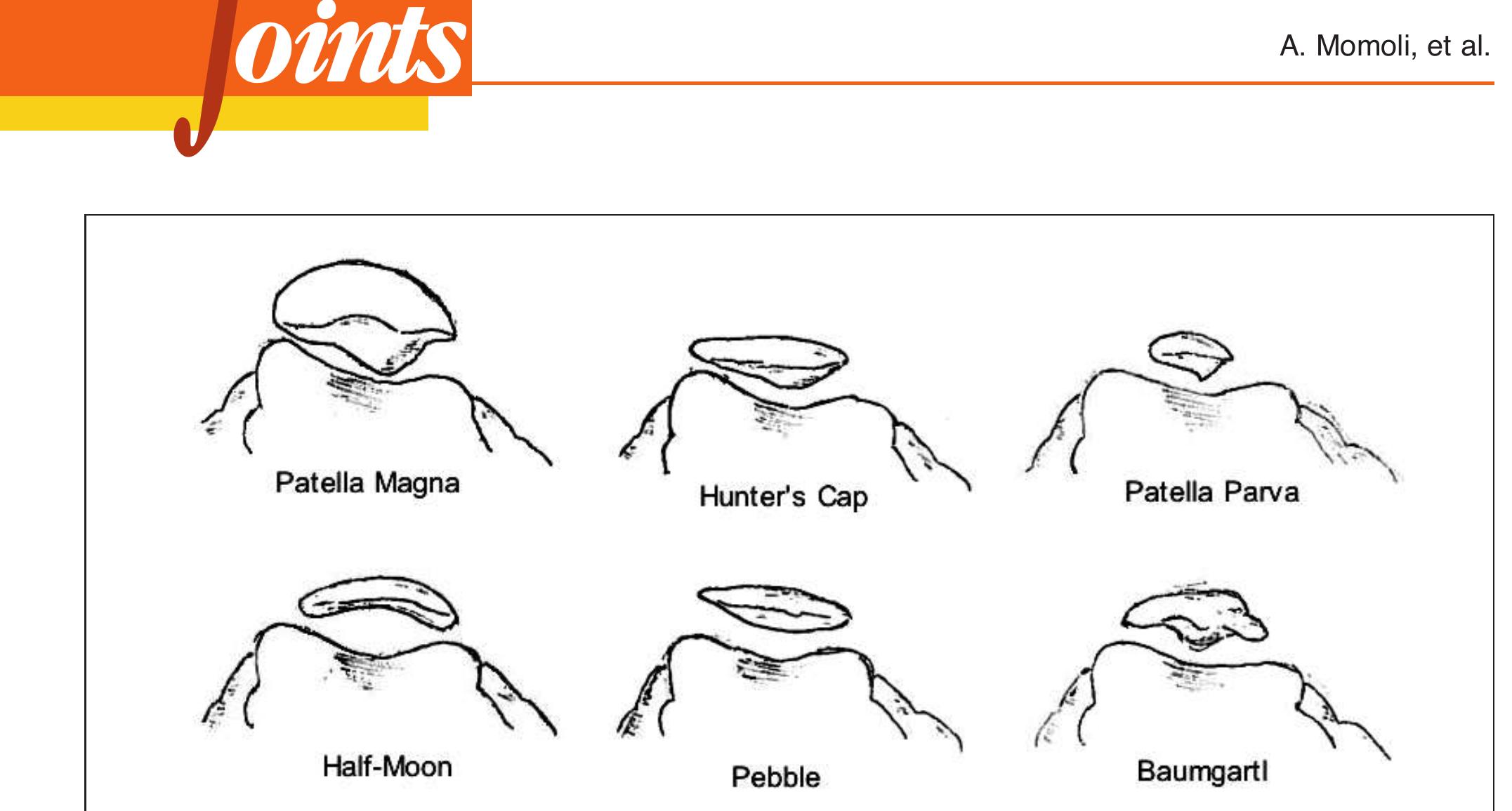 Wiberg’s classification of different patella types (ref.