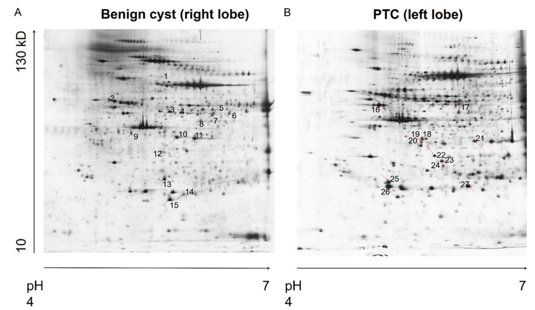 Representative 2-de maps of benign thyroid cyst and ptc