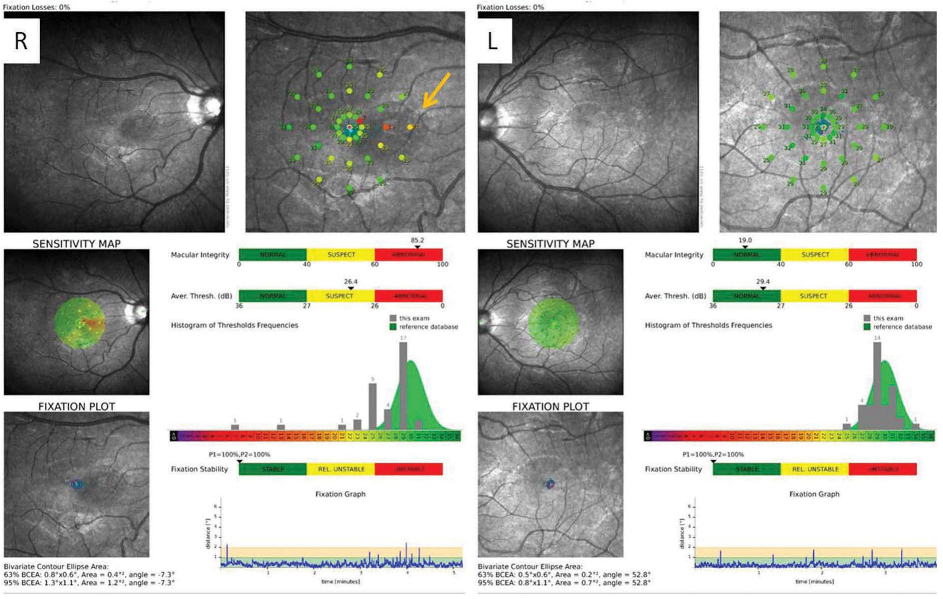 Macular integrity assessment microperimetry test of the