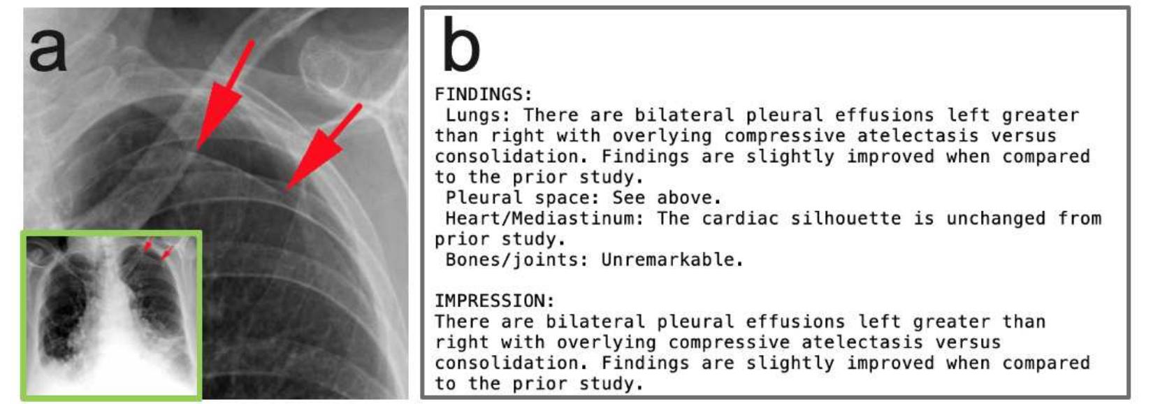 Figure 3 - Pneumothorax and chest tube classification on
