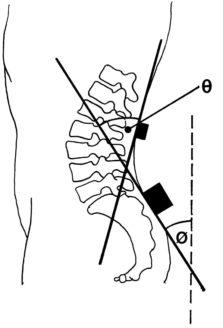 “sacral angle” (q) was the angle between the vertical and
