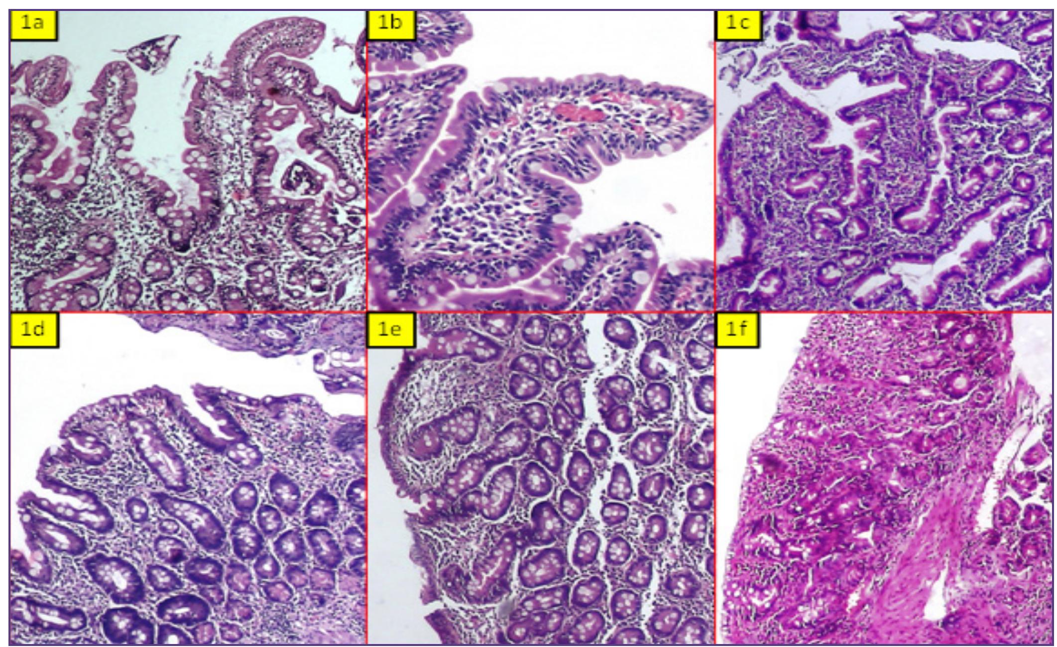 A. duodenal biopsy showing normal histomorphology, h&e 40x;