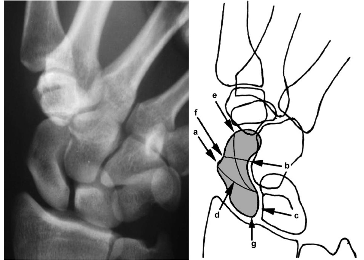 Pa/postero-anterior/view in ulnar deviation of wrist and