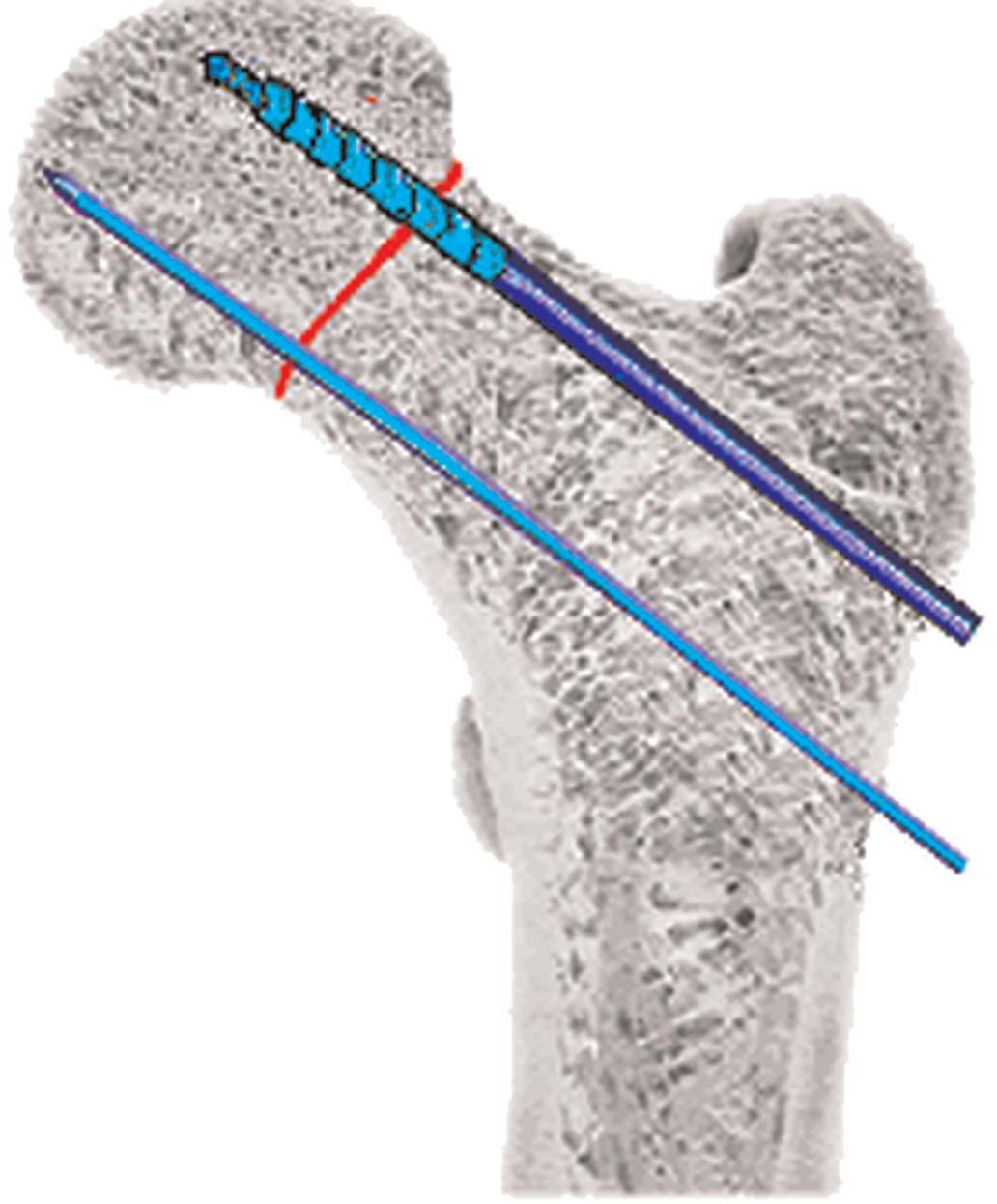 (PDF) Osteoscopy for Assessment of Blood Supply to the Femoral Head