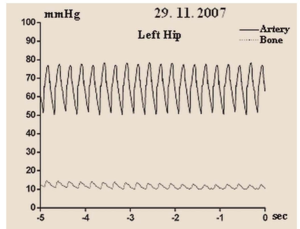 (PDF) Osteoscopy for Assessment of Blood Supply to the Femoral Head