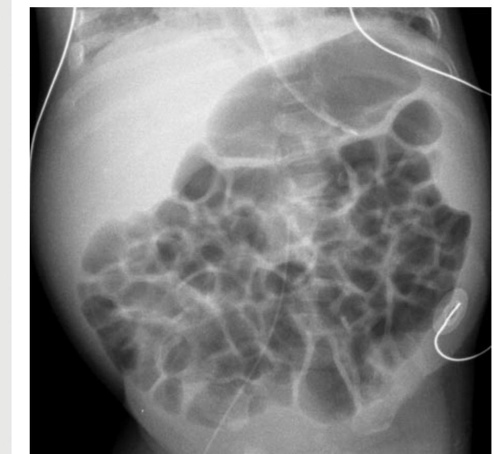 Supine radiograph of the abdomen of a normal neonate shows a