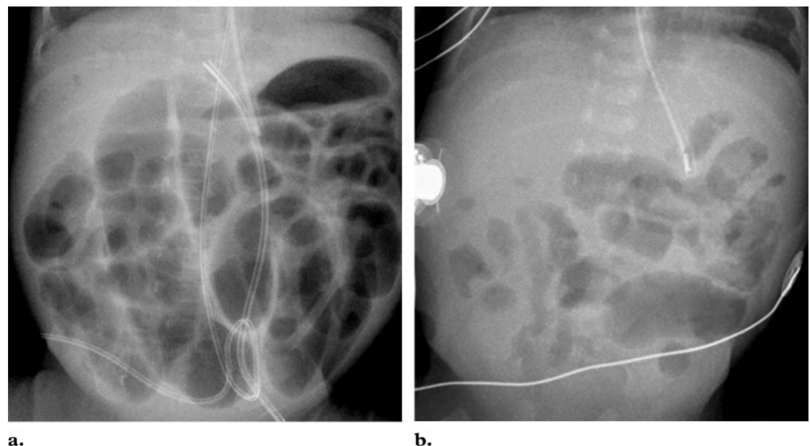 Supine abdominal radiographs obtained at initial
