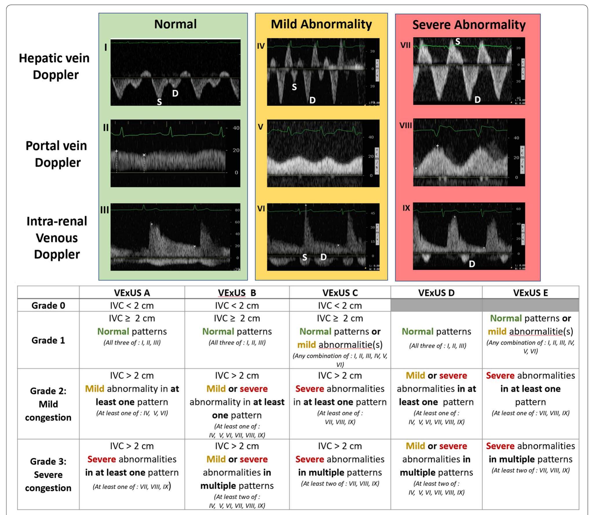 The venous excess ultrasound (vexus) grading system