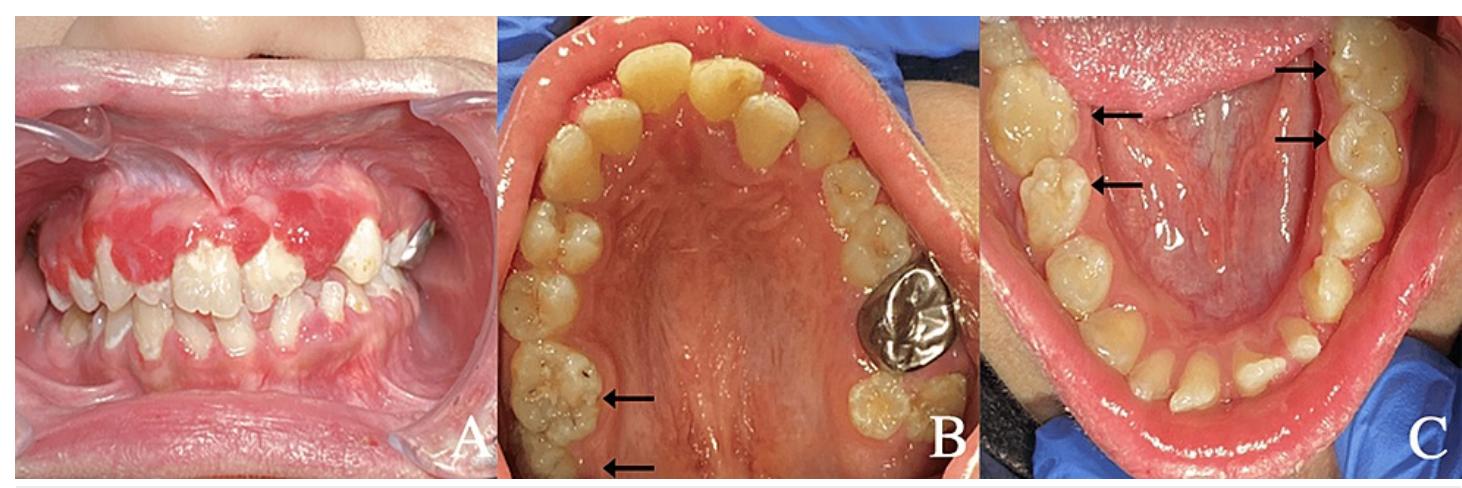 Hypoplasia with abnormal tooth formation, malalignment of