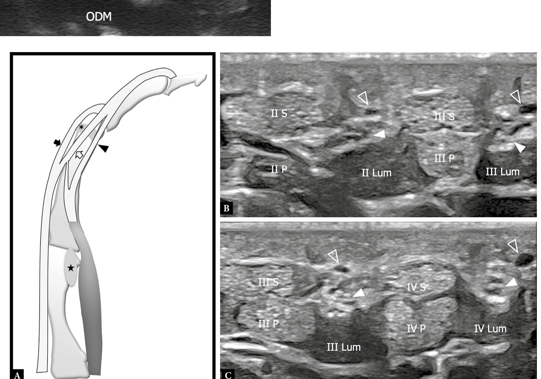 G. 7. lumbrical muscles, normal anatomy. a. schematic