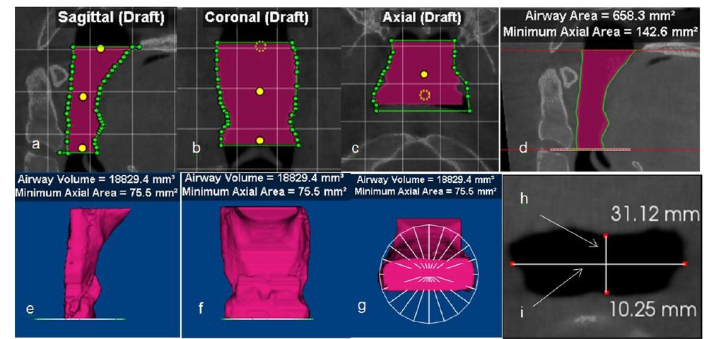 Oropharyngeal airway. (a) surface area (sagittal view). (b)