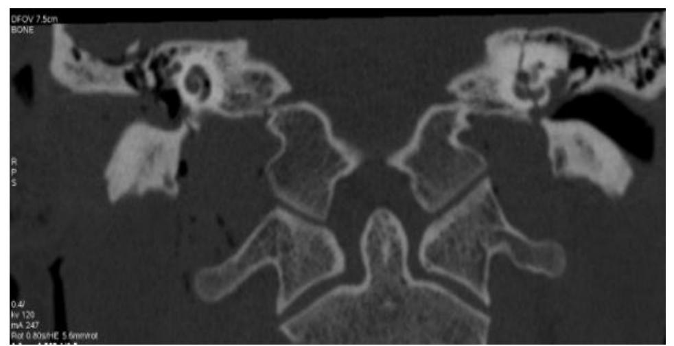 (PDF) Bilateral temporal bone fractures: a case report
