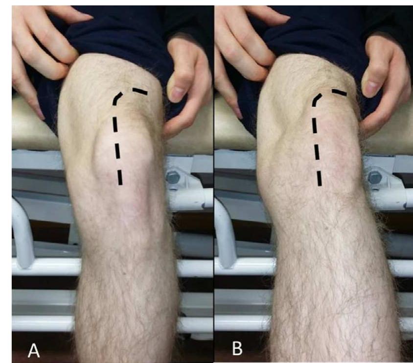 (PDF) The J-sign in patellar maltracking