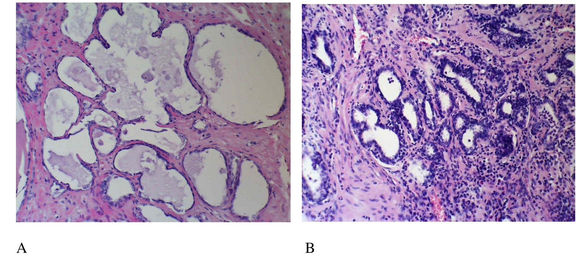 Figure 2 - Different Types of Atrophy in the Prostate With