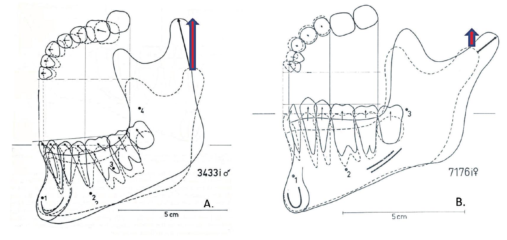 Variations in mandibular condylar growth direction, tooth