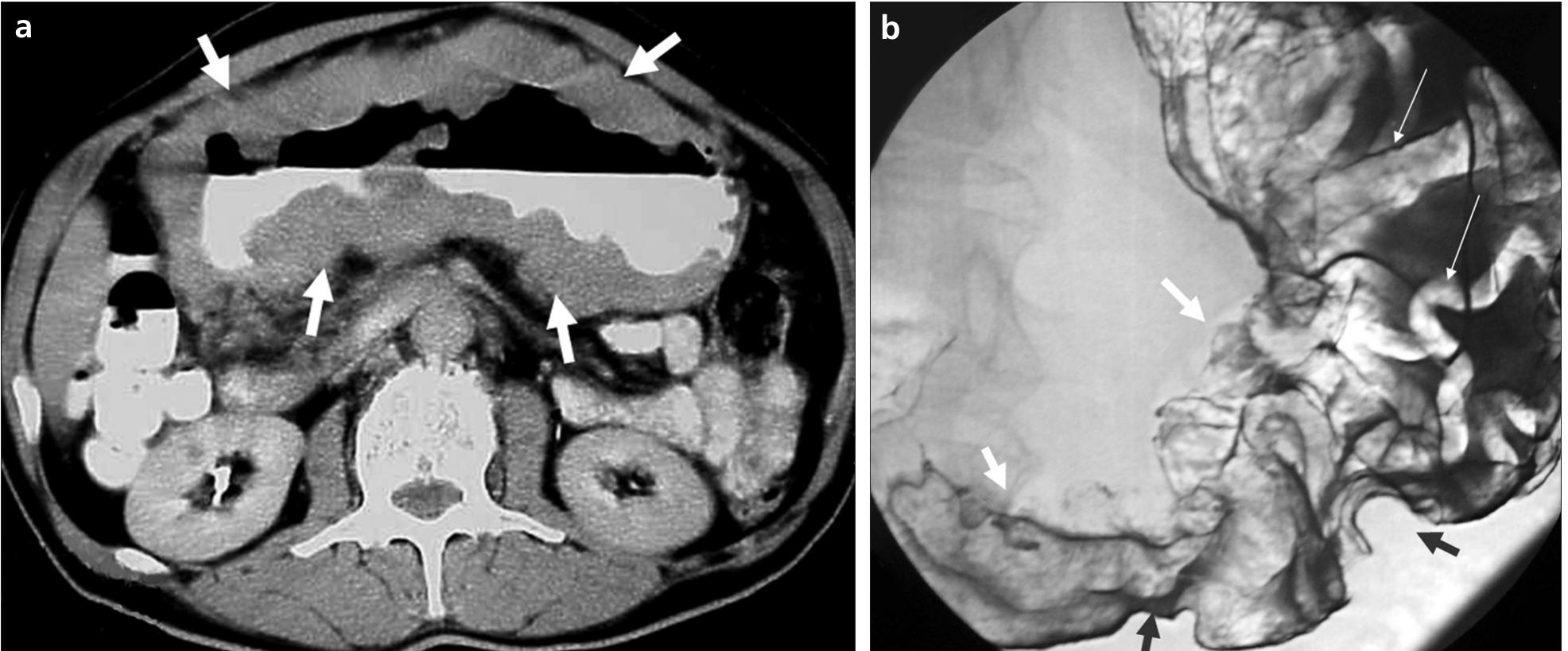 A B B Cell Type Non Hodgkins Lymphoma Of The Stomach In A 9841