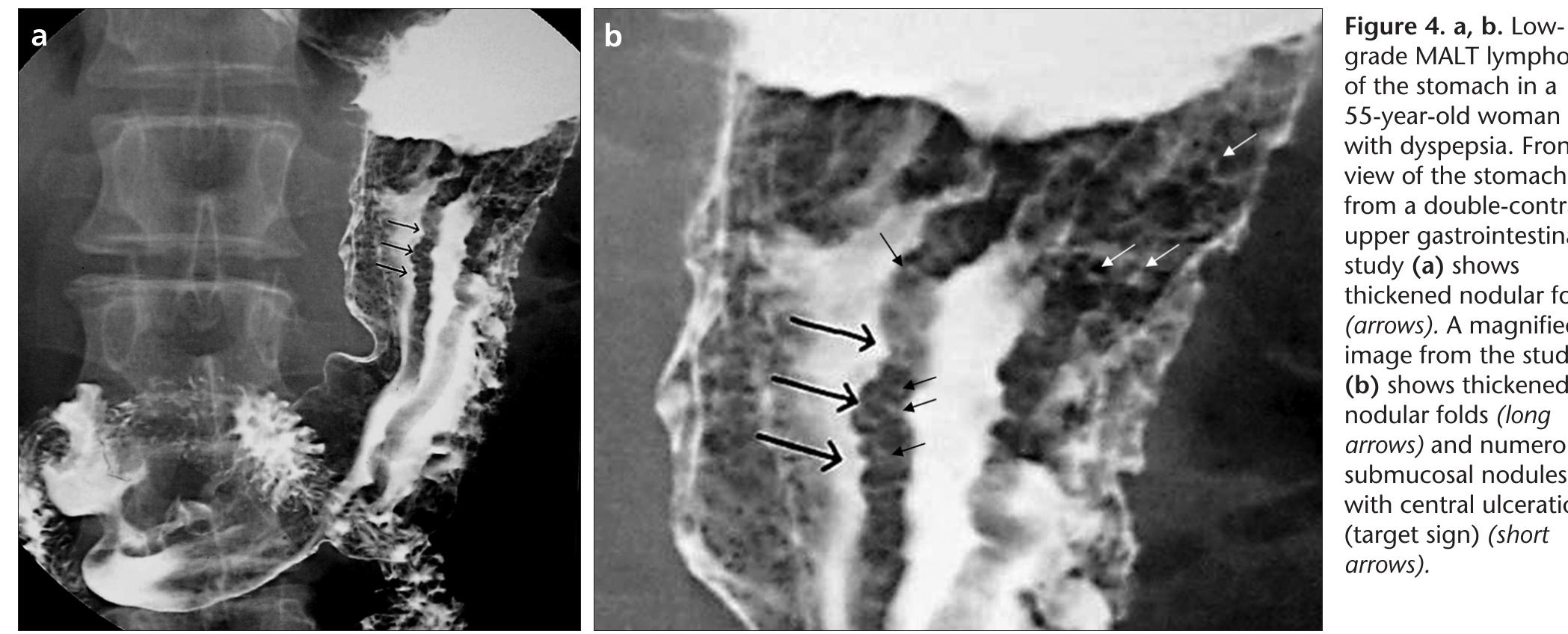 Gastrointestinal lymphoma: a spectrum of fluoroscopic and ct