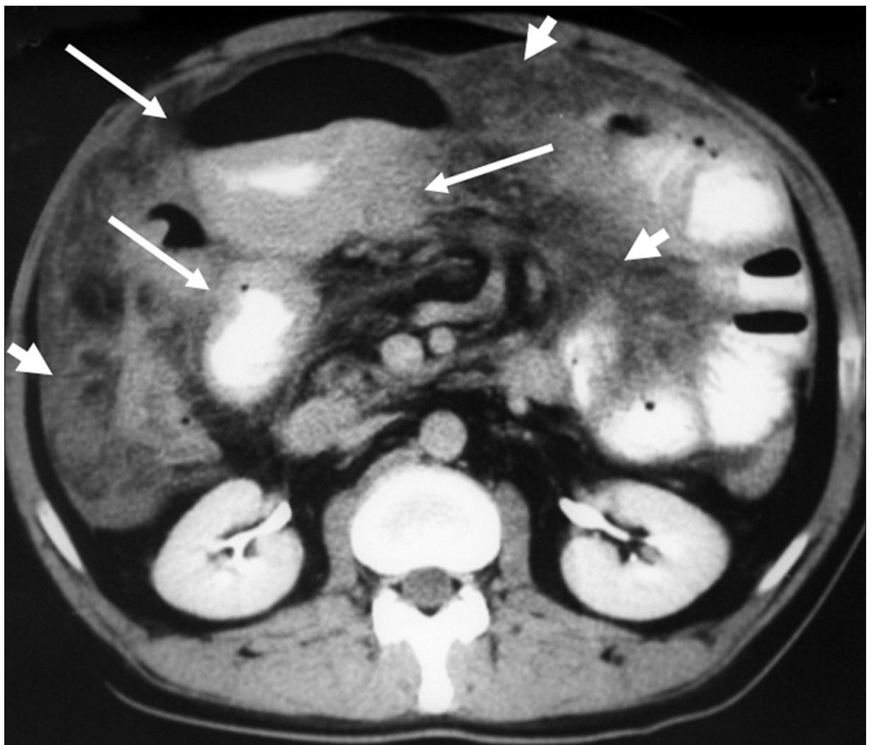 Figure 8 - Gastrointestinal lymphoma: spectrum of