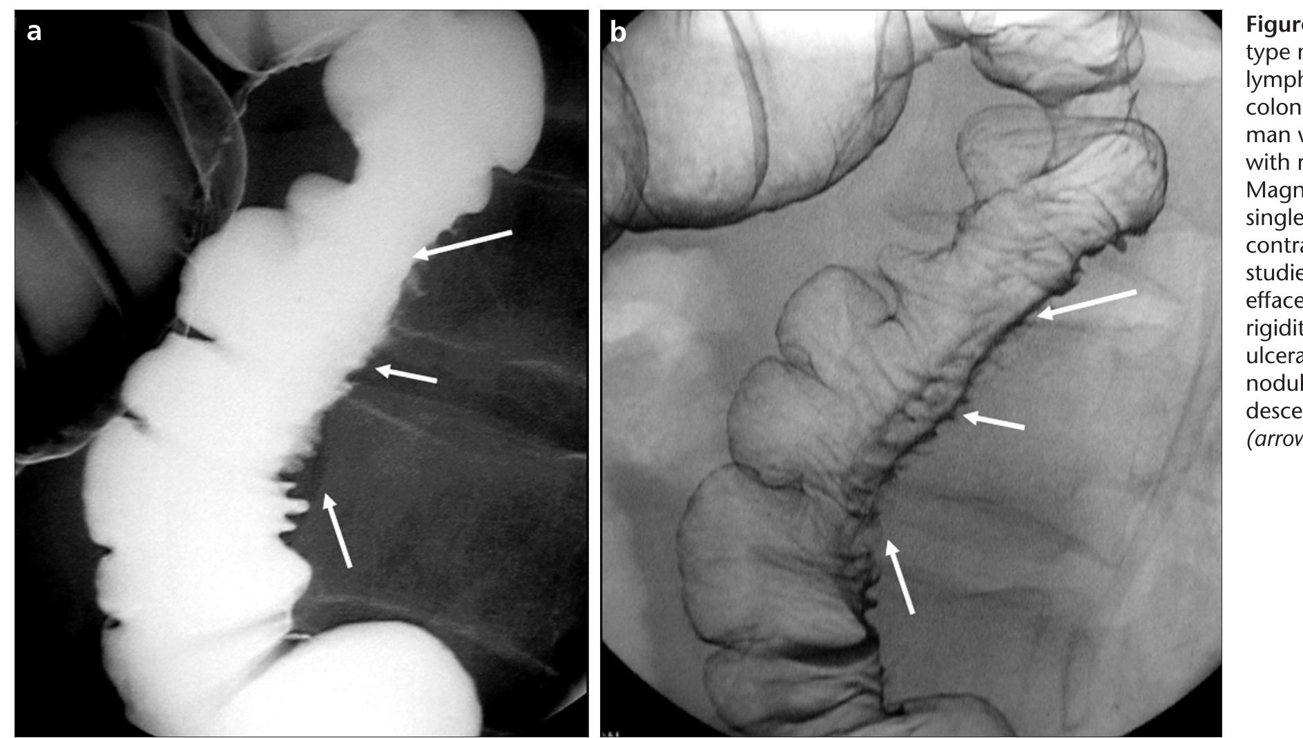 Gastrointestinal lymphoma: a spectrum of fluoroscopic and ct